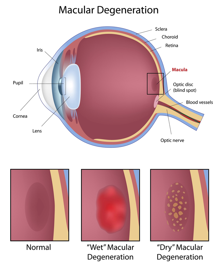 Macular Degeneration Ophthalmic Consultants NY