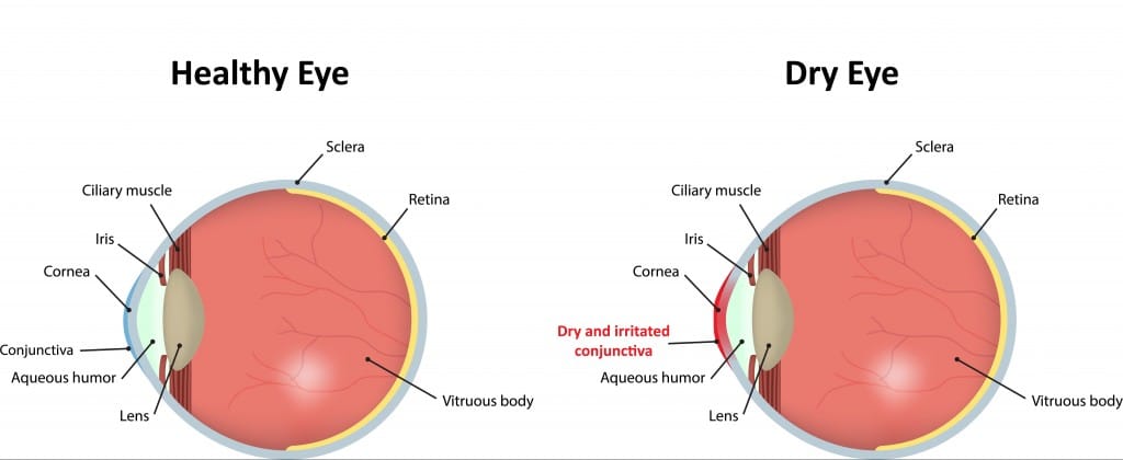About Dry Eye Syndrome | Ophthalmic Consultants, NY