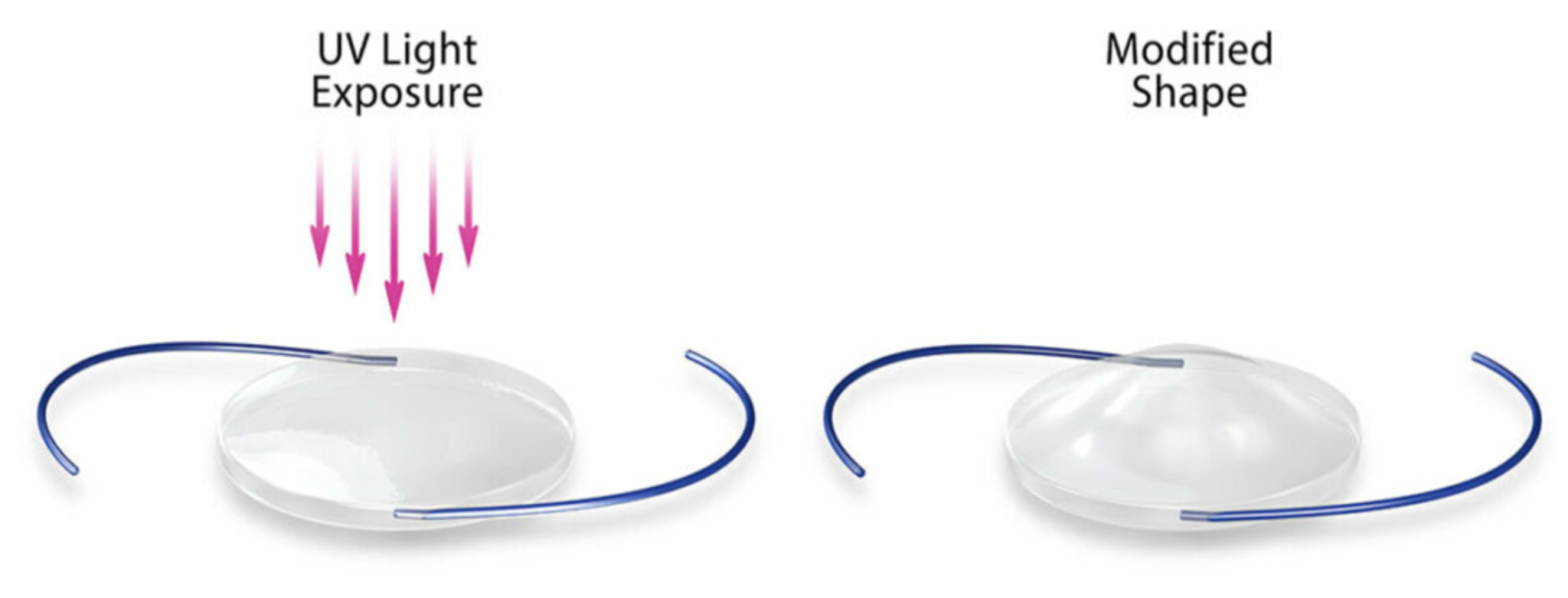 The First and Only Lens That Can Be Customized AFTER Cataract Surgery ...